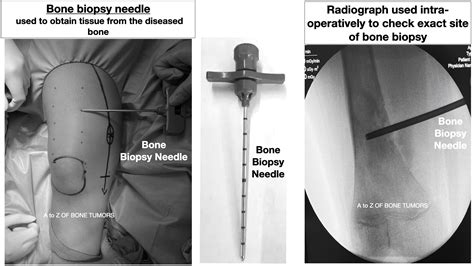 Bone Biopsy What Is This Medical Test Or Procedure Cancer Complete Care