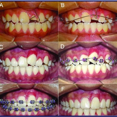 The Impaction Depth Ramus Relationship And Angulation Classification
