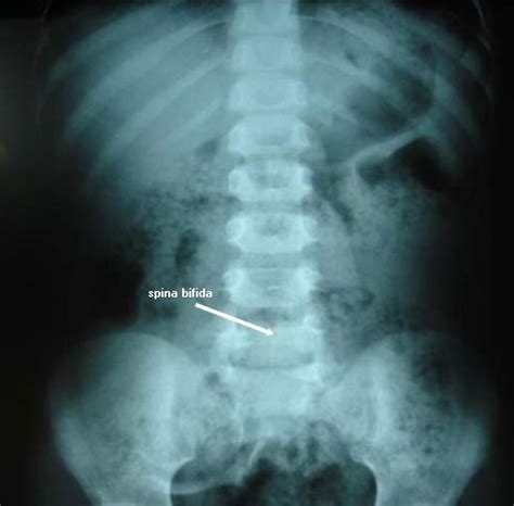 Spina Bifida General Pacs