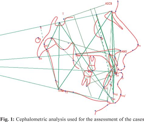 Figure 1 From Dentoskeletal Modifications In Class Ii Deep Bite