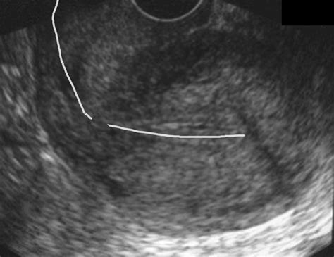 Retroflexed Uterus Mri