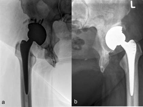 A Postoperative Radiography Of The Right Hip With The Osteoconductive