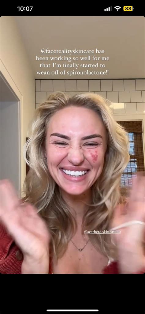 Mikayla Zazon— 3 Rounds Of Accutane Secretly Taking Spironolactone Yet