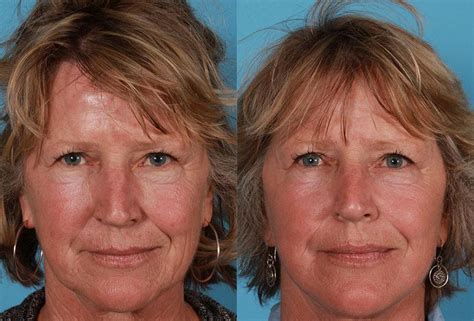 Patient 130114 Limited Incision Facelift Before And After Photos