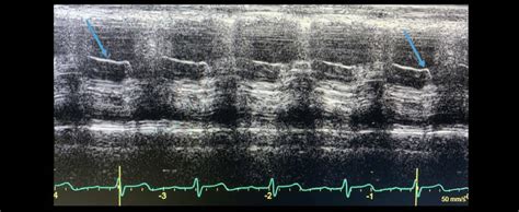 Echo Basics Pulmonary Valve • Litfl • Radiology Library