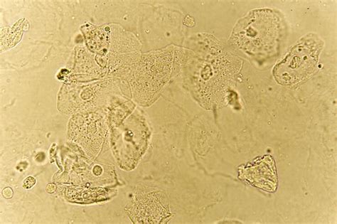 Premium Photo Epithelial Cells With Bacteria In Patient Urine Urinary Tract Infections Analyze