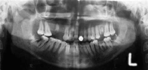 Unusual Presentation Of Chronic Hyperplastic Pulpitis A Case Report