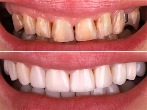 The Art And Science Of Dental Restorations Ravish Magazine