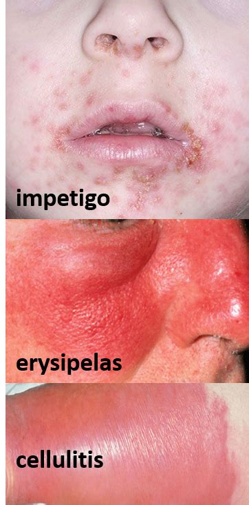 Erysipelas Vs Cellulitis