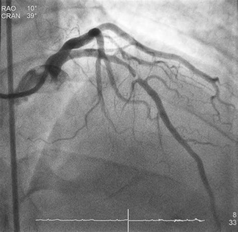 Coronary Angiogram Procedure In Dubai At Emirates Hospitals