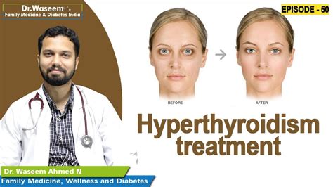 Hyperthyroidism Treatment Dr Waseem Episode 50 English Health