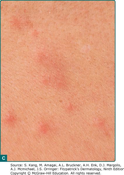 Polymorphous Light Eruption Lupus