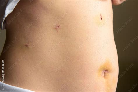 Womans Belly With Medical Stitches After Surgery By Laparoscopy Stock