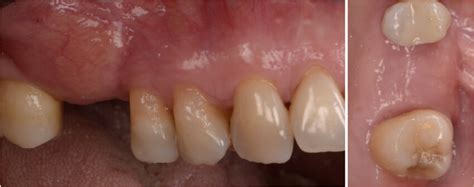 At 6 Months Both The Hard And Soft Tissue Augmentation Is Evident Download Scientific Diagram