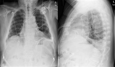 Early Postoperative Pa Right And Lateral Chest X‐ray Showing Intact