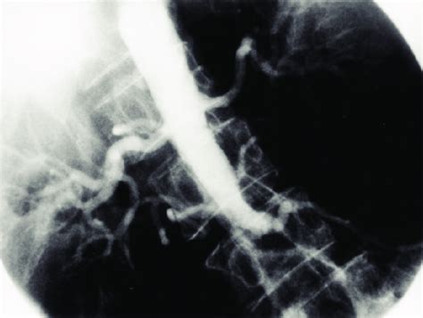An Abdominal Aortogram Showing Total Occlusion Of The Bilateral Common