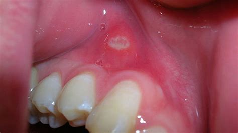 What Does Mouth Cancer Look Like 5 Pictures Of Mouth Cancer