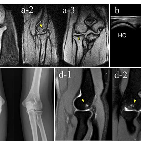 A False Negative Ocd Case With Mobile Mri Case 1 Mobile Mri Us