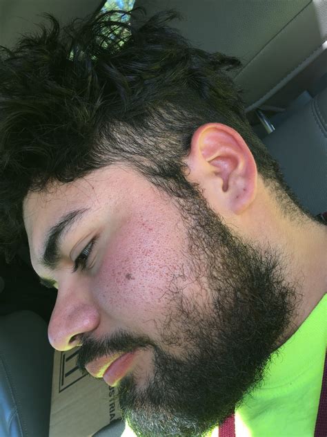 How Do I Get Rid Of These Ugly Scars On My Face Acne Scars
