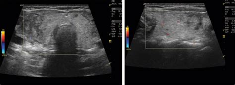 Cervical Ultrasonography Performed At The Emergency Department