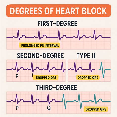 Heart Blocks Made Simple First Second Third Degree Explained