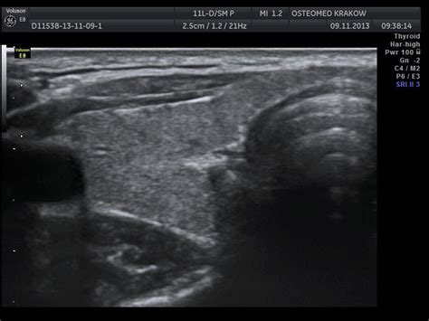 Graves Basedowa Icd 10 At Amy Macartney Blog