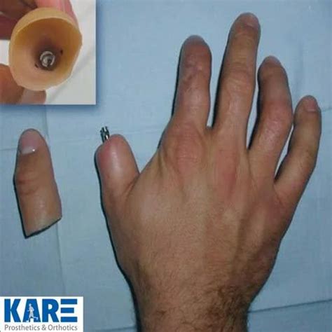 Silicone Partial Finger Prosthesis At Best Price In Bengaluru