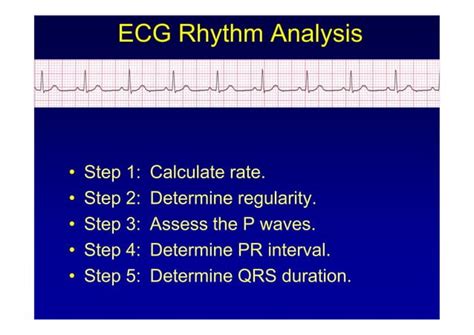 Ecg Rhythm Interpretation Ecg Rhythm Analysis Pdf
