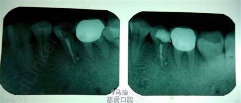 意外的侧支根管 医联