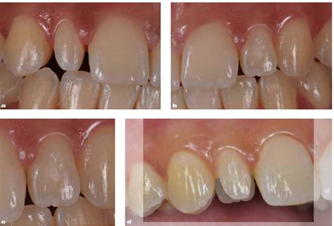 A And B Right Conoid Tooth And Left Lateral Views In Mi