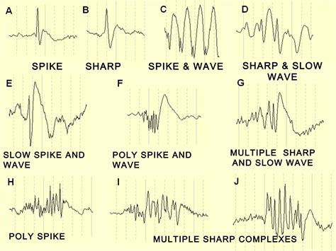 Neuro Physiology Of Seizures And Eeg Pedaitric Neurologist Dr Amit