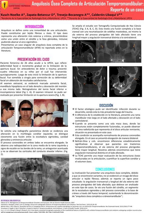 Pdf Anquilosis ósea Completa