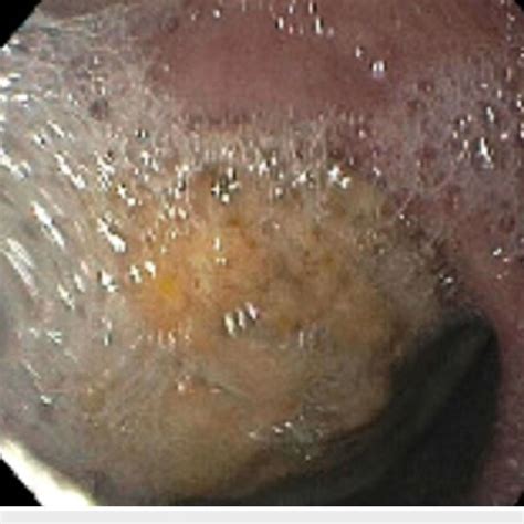 Upper Endoscopy The Image Shows The Upper Third Of The Esophagus With