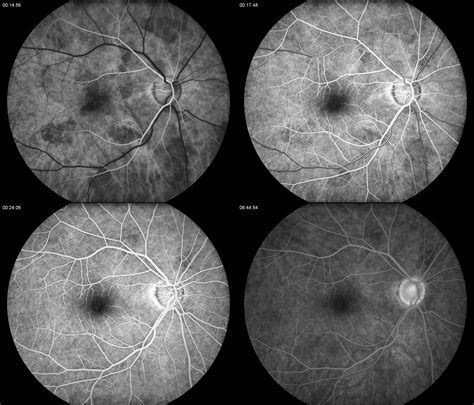 Application Of Fluorescence Angiography At Jenenge Blog