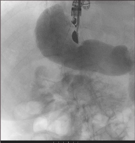 Fluoroscopy Image Showing Injection Of Contrast Into The Excluded