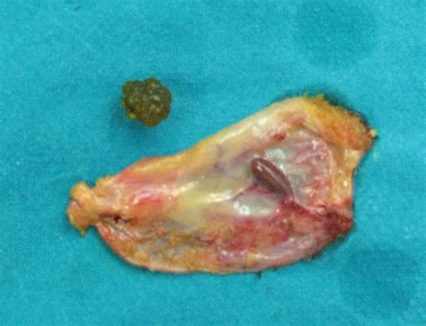 Surgical Specimen After Gallbladder Was Opened Shows The Mass Ectopic