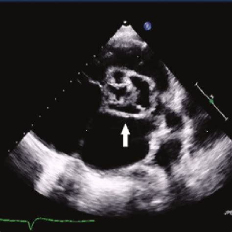 Aortic Valve Abscess Arrow Download Scientific Diagram