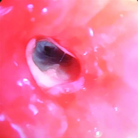 Photo From Bronchoscopy Showing Endobronchial Cheesy Material