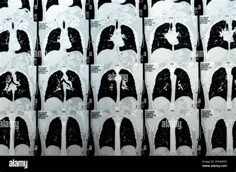 Multi Slice Ct Scan Of The Chest Showing Normal Study Normal