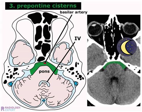 Ct Brain Hemorrhage