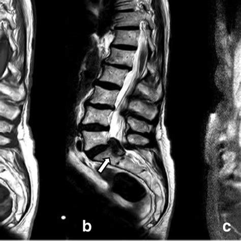 Pdf Hemorrhagic Ligamentum Flavum Cyst Associated With Adjacent Bone