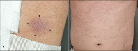 A A 2×2 Cm Sized Hyperpigmented Nodule On The Left Arm B Multiple