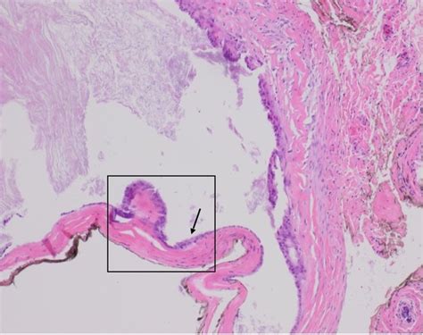 Eyelid Cyst Histology Pathology Of The Eyelids Springerlink