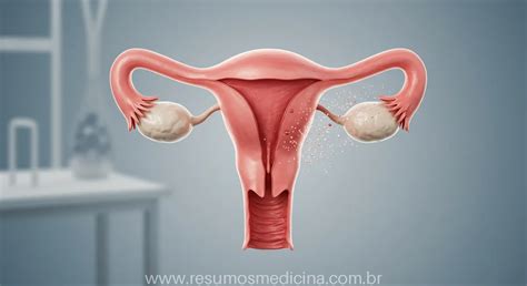 Síndrome De Rokitansky Mrkh O Guia Completo Sobre Causas