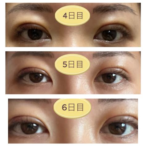 二重埋没後に黒い点ができる原因は？埋没法体験者が教える失敗しないクリニック選び うさぎちゃん美容ブログ