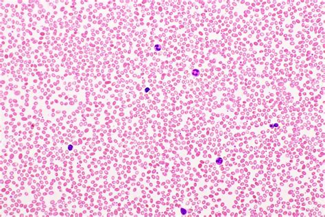 血液涂片中的红细胞和白细胞 库存图片 图片 包括有 血小板 抽象 显微镜 贫血 红色 厌恶 243860165