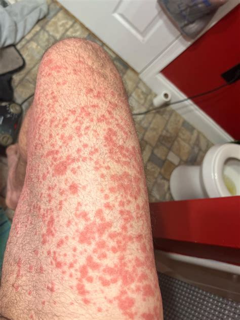 Anyone Have Scalp Psoriasis Like This What Do You Do To Help R