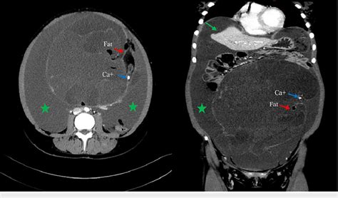 Axial And Coronal Cect Of The Abdomen And Pelvis Showing A Large