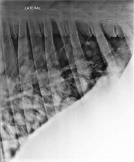 Lateral Radiograph Of Chest Showing Severe Diffuse Nodular Interstitial