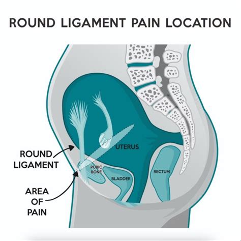 Round Ligament Pain Causes Symptoms Diagnosis Treatment And More